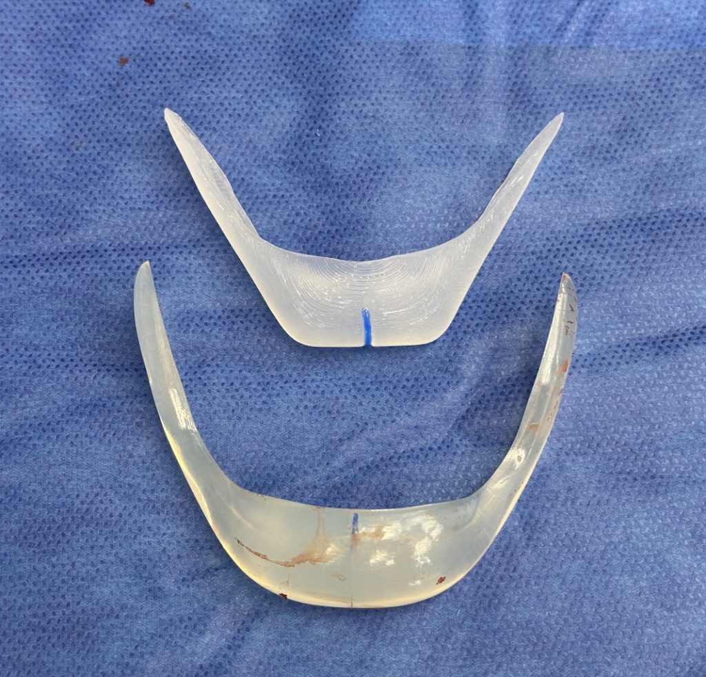 PLastic Surgery Case Study - Correcting Chin Implant Asymmetry and ...