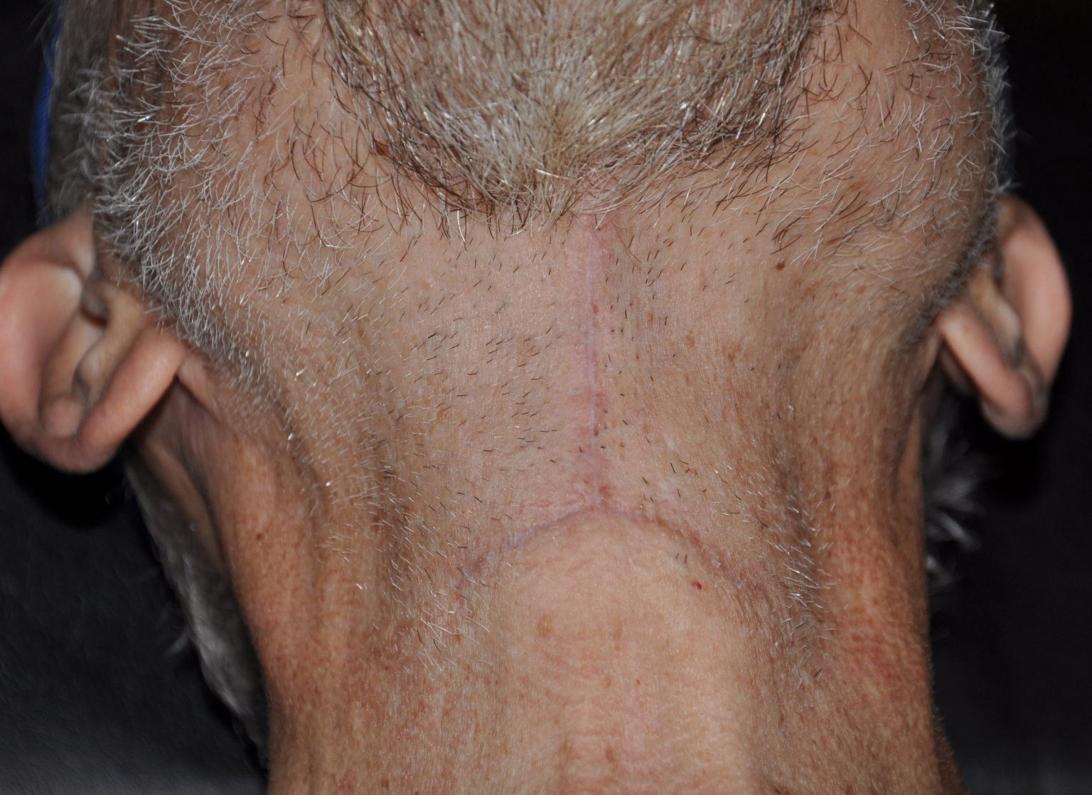 The Essential Steps in the Direct Necklift - Explore Plastic Surgery