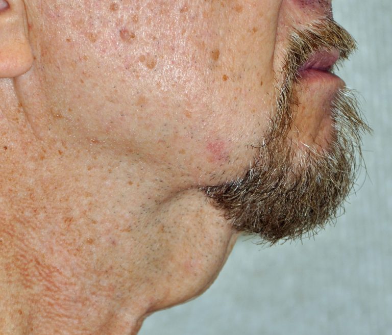 The Essential Steps in the Direct Necklift - Explore Plastic Surgery