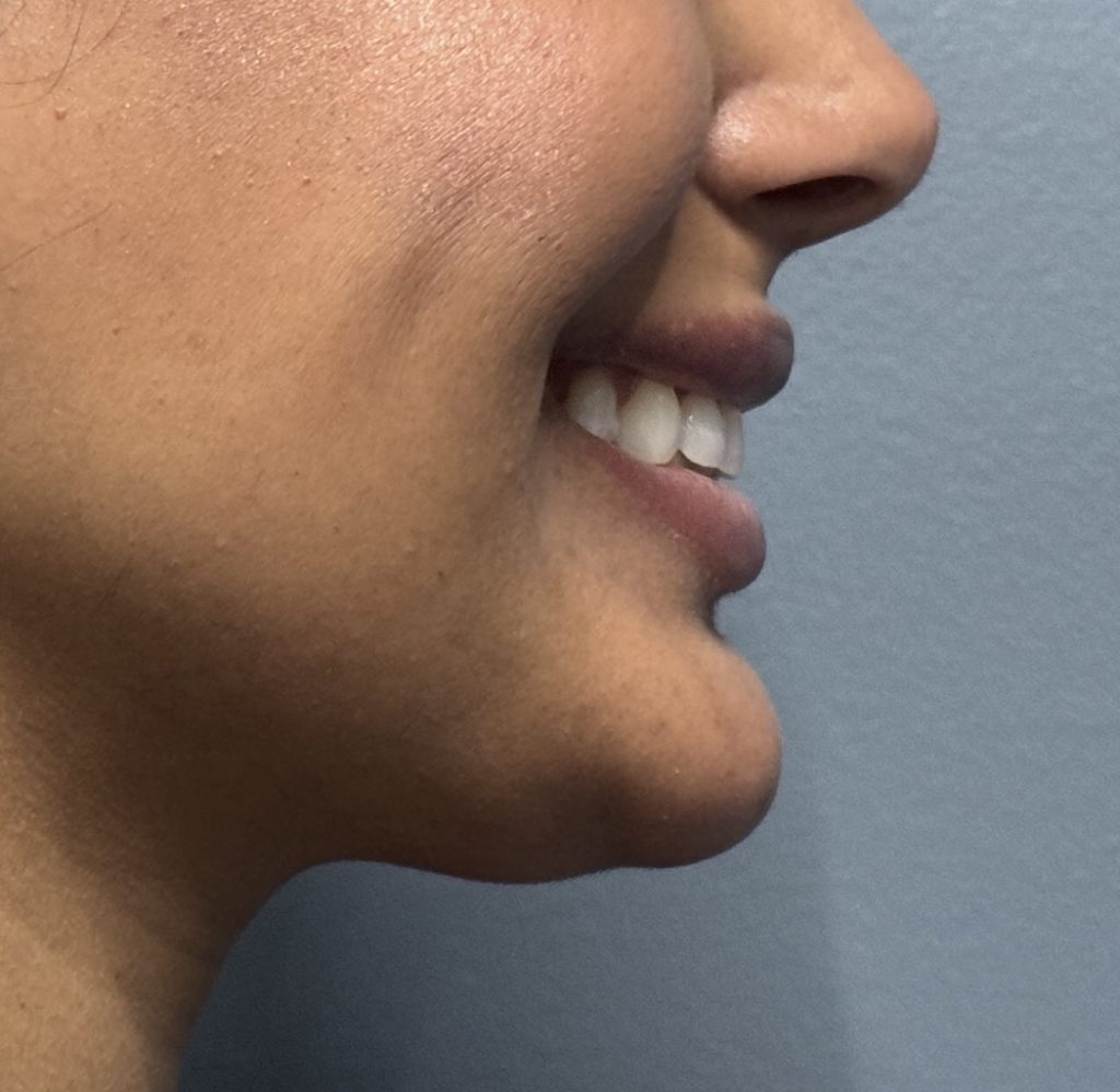 Plastic Surgery Case Study - Submental Technique for Chin Deprojection ...