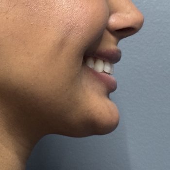 chin reduction Archives - Explore Plastic Surgery