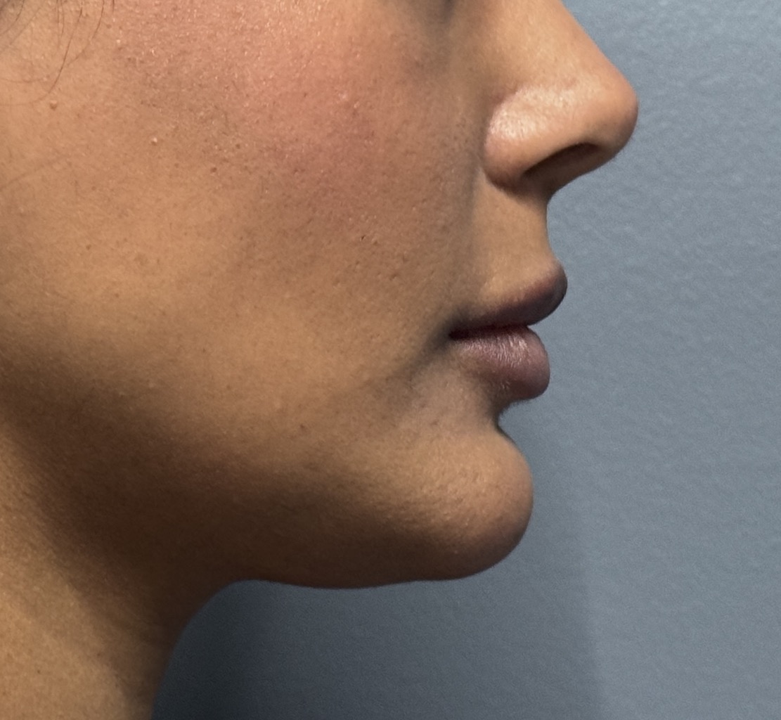 female over advacned sliding genioplasty side view Dr Barry Eppley ...