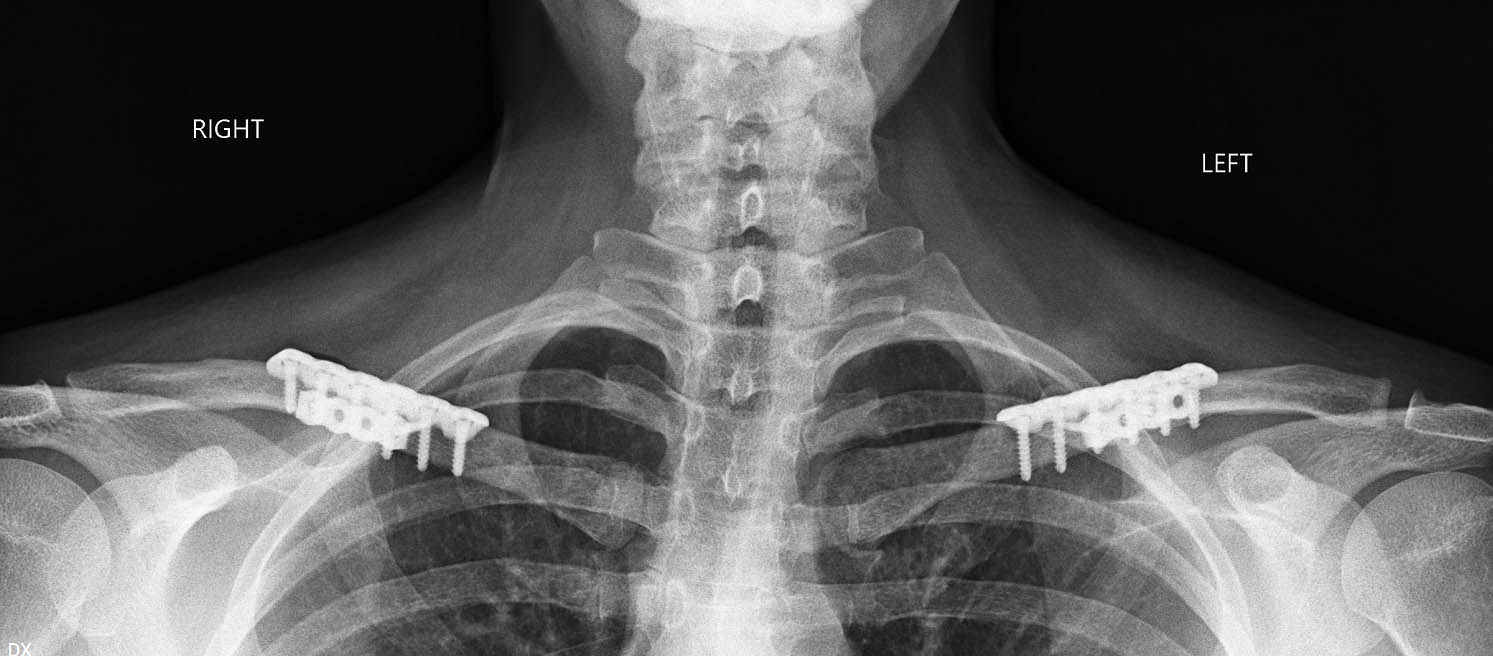 female shoulder reduction postop x ray Dr Barry Eppley - Explore ...