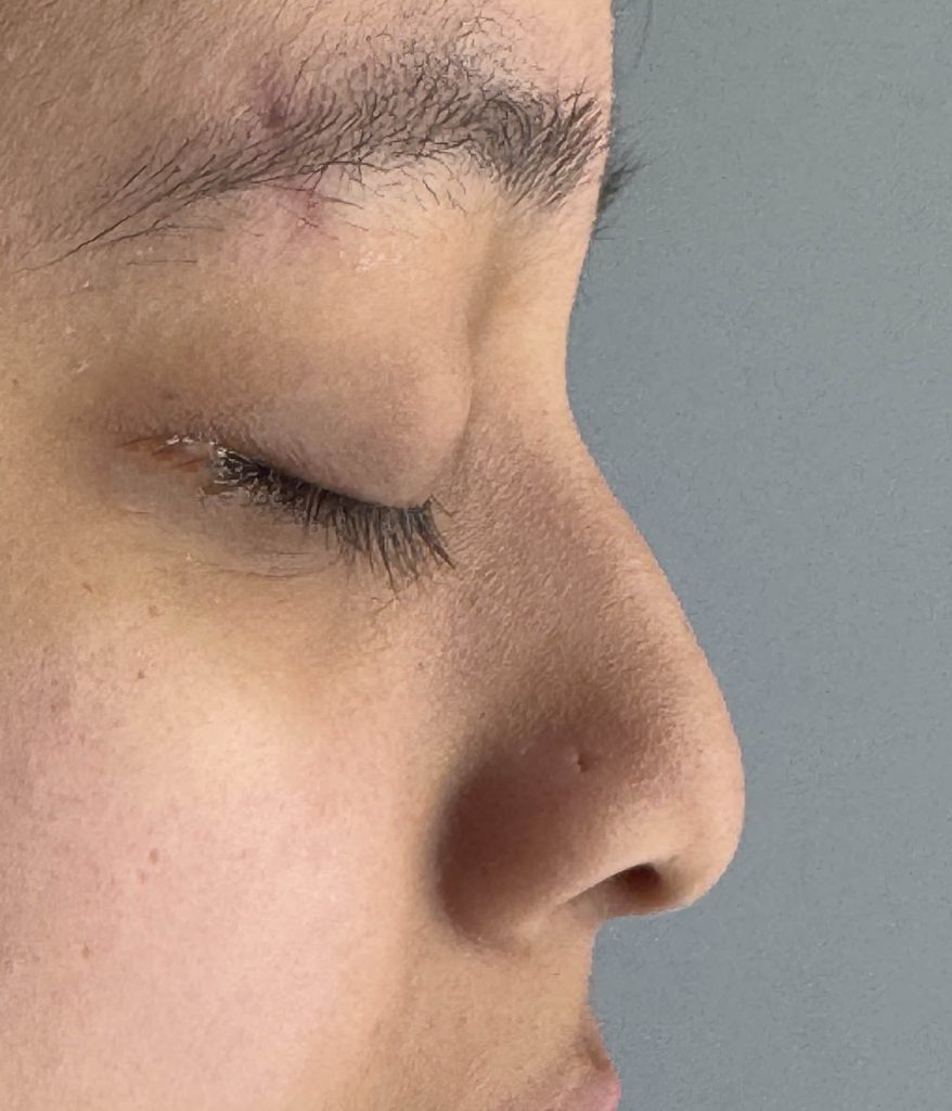 Plastic Surgery Case Study - Rhinoplasty of the Female Juvenile Nose ...