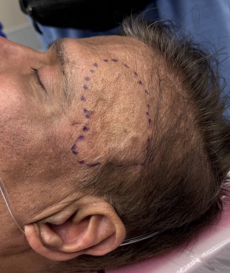 Plastic Surgery Case Study - Temporal Implant Replacements for ...