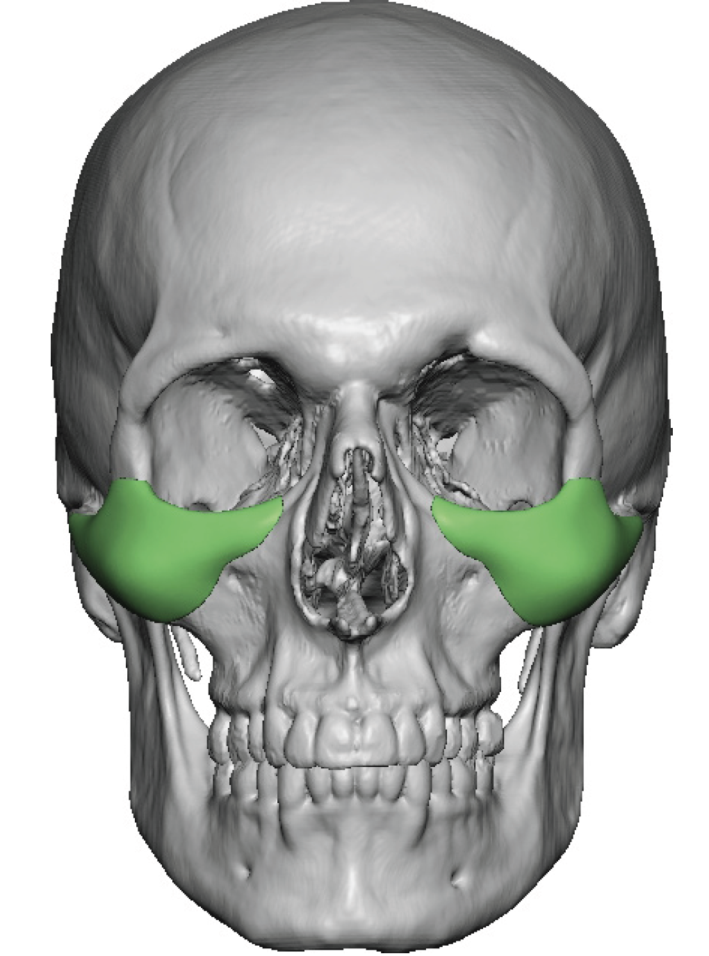 male custom infraorbital-malar implants design front view Dr Barry ...