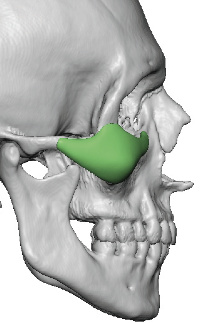 male custom infraorbital-malar implants design side view Dr Barry ...