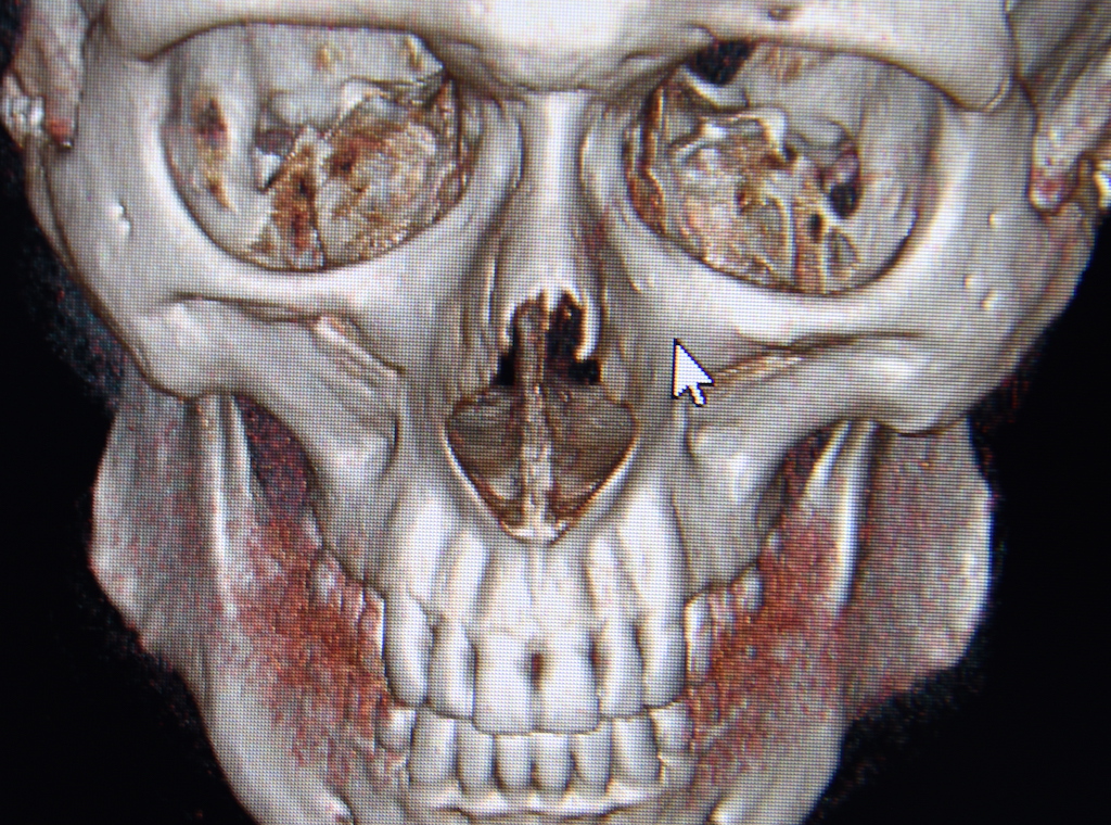 male deep muscle fosas of mandibular ramus 3D CT scan front view Dr ...