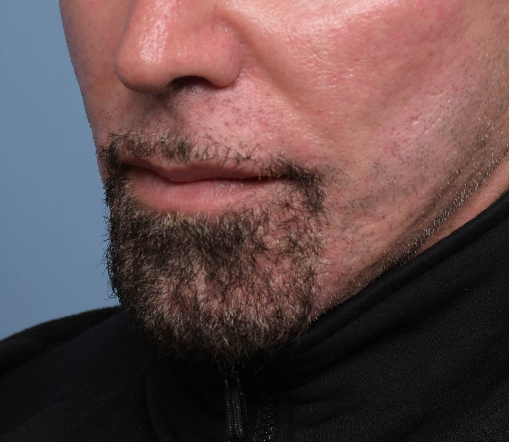 Plastic Surgery Case Study - Custom Square Chin Implant Replacement for ...