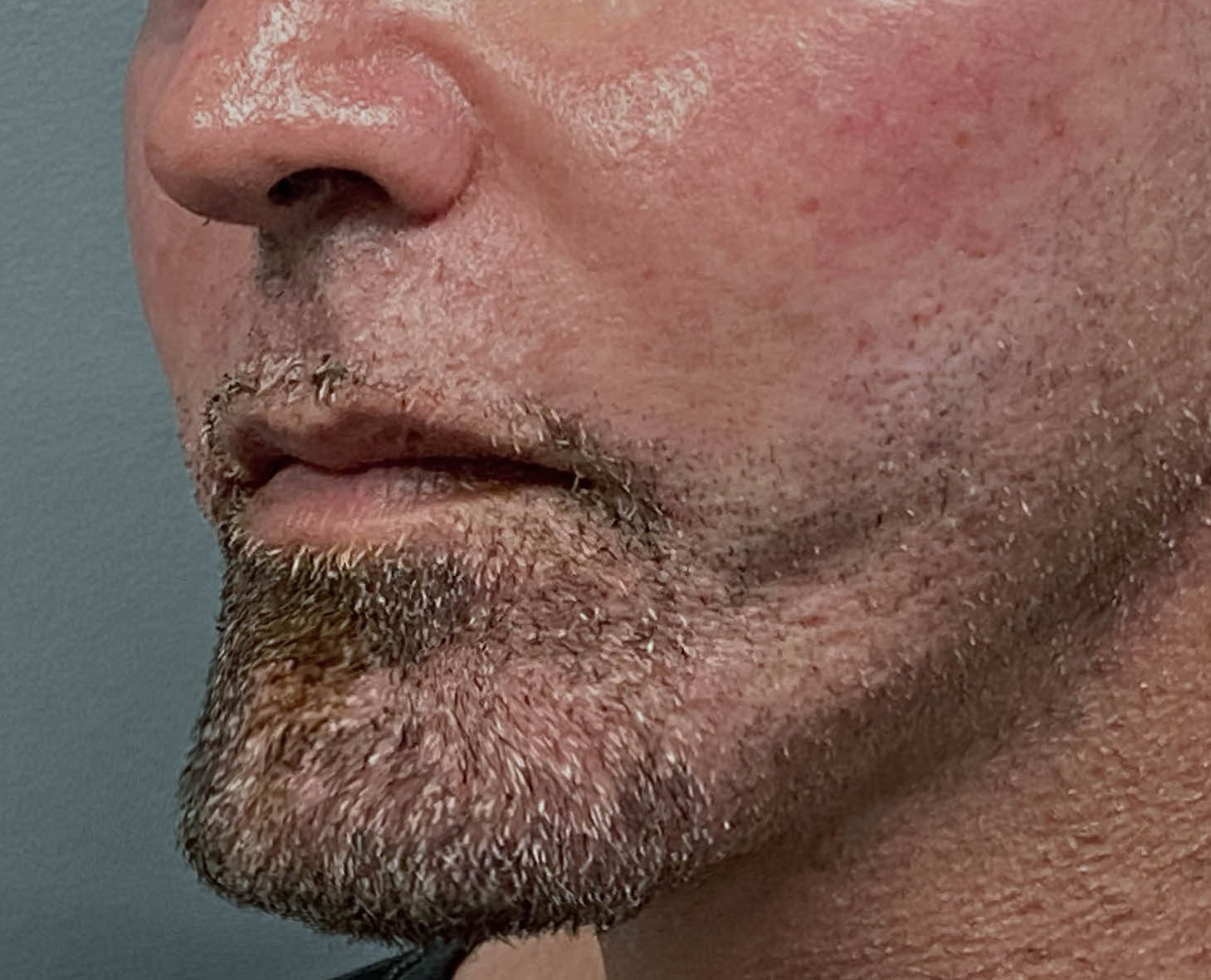 Plastic Surgery Case Study - Custom Square Chin Implant Replacement for ...