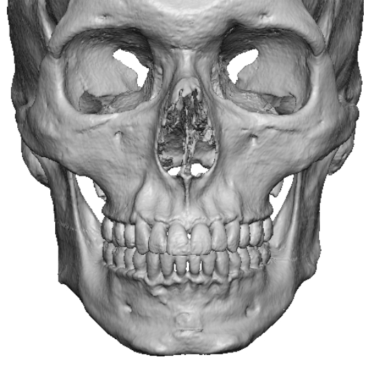 masseter miuscle bony anatomy 3D CT scan front view Dr Barry Eppley ...