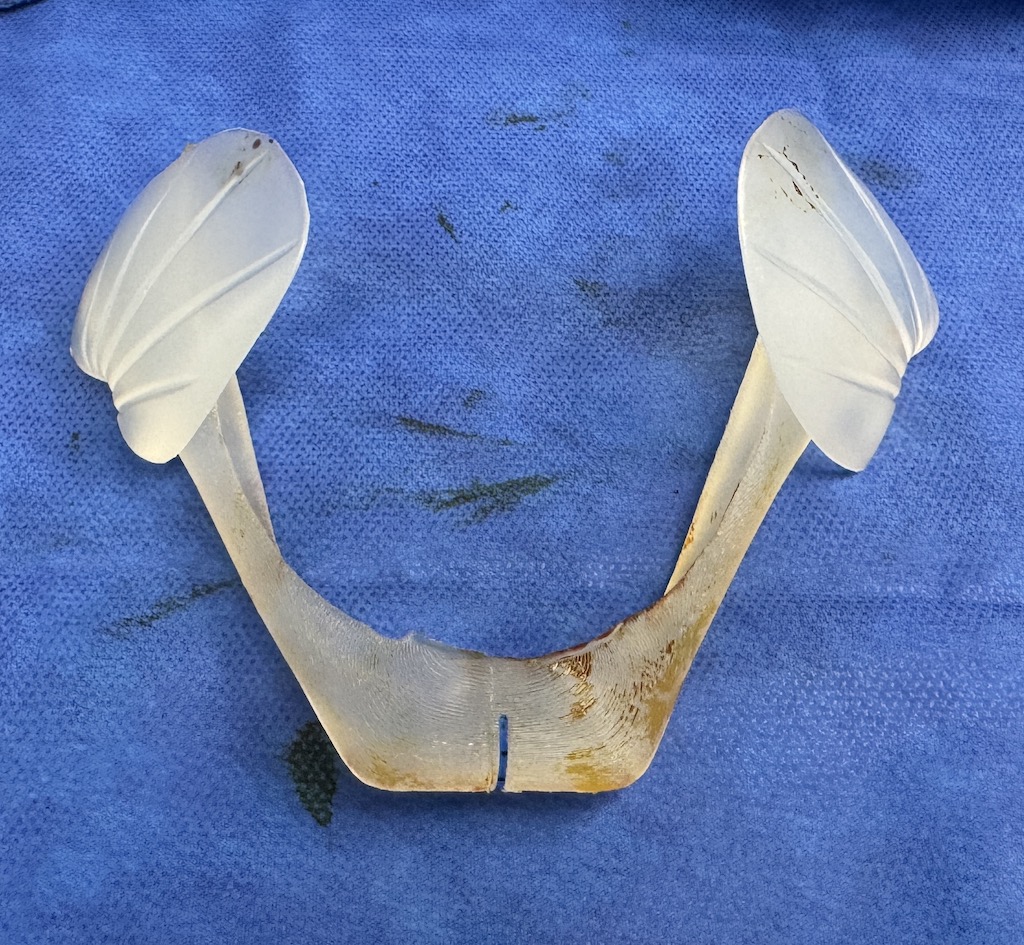 masseter muscle implant add ons to cusotiom jawline implant front view ...