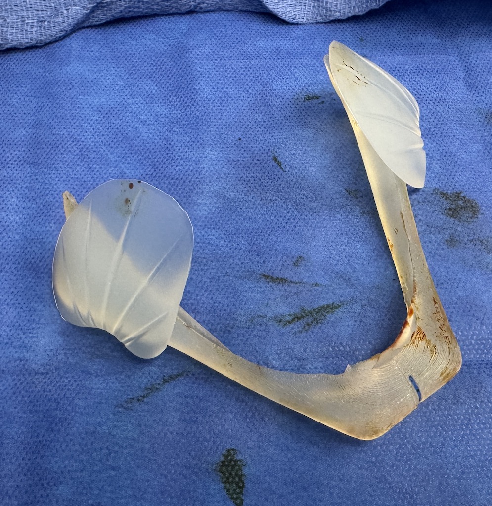 Technical Strategies - Achieved the Muscular Jaw Angle Look in Custom ...