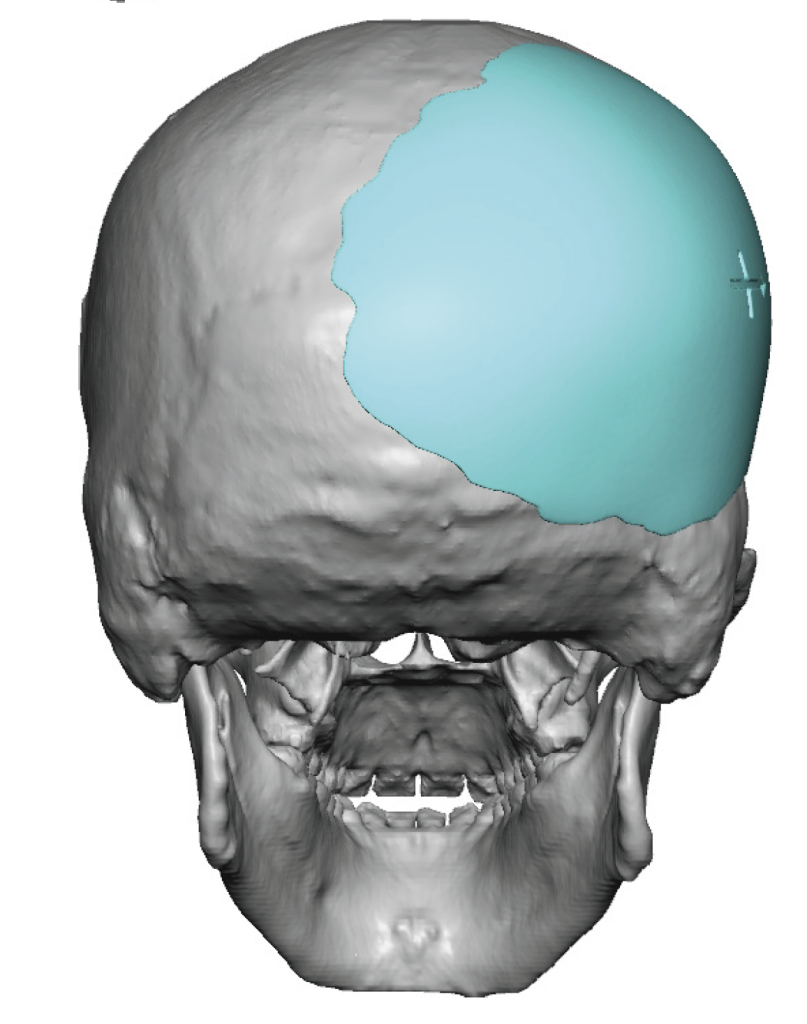 Plastic Surgery Case Study - Custom Skull Implant for Correction of ...
