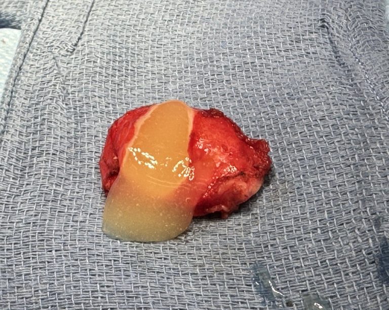 Silicone Scrotal Injections and Custom Testicle Implants - Explore ...