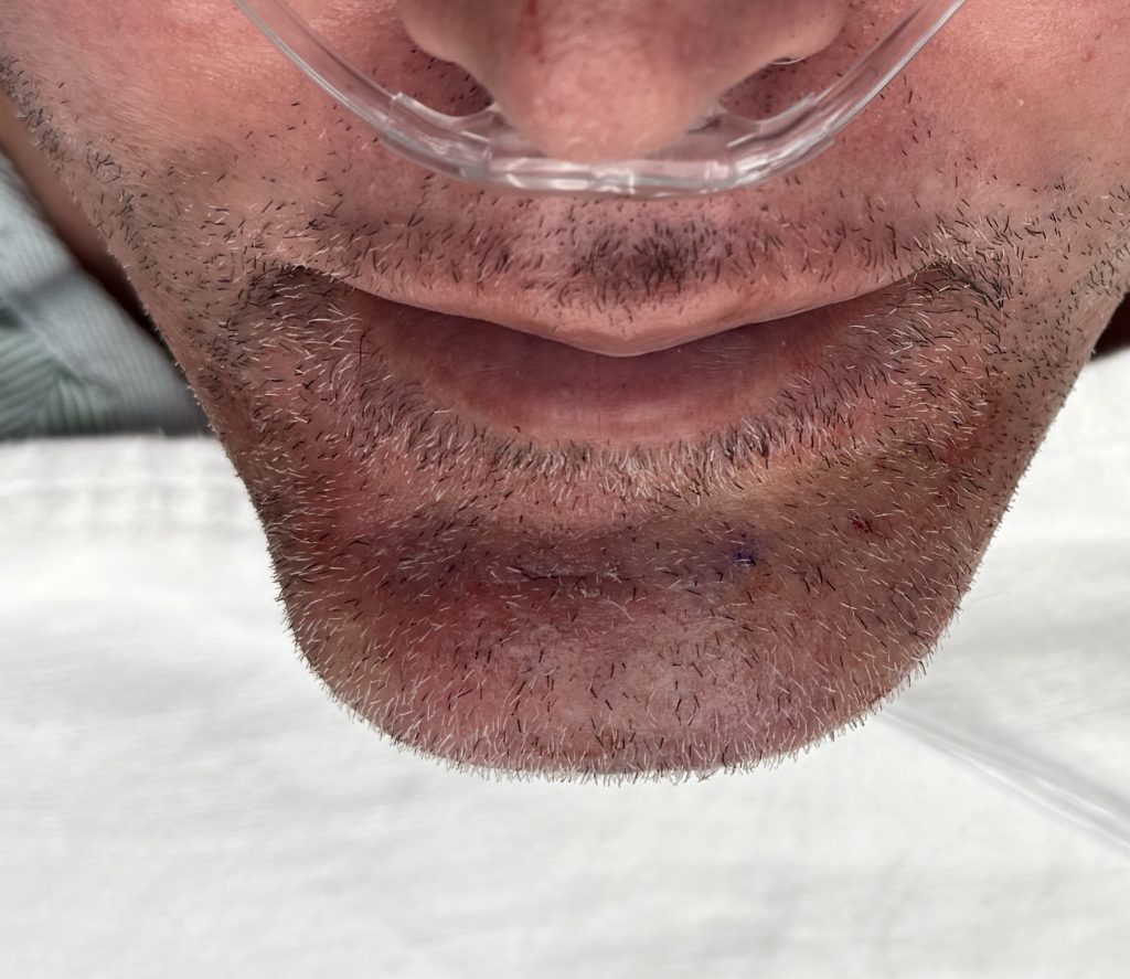 Technical Strategies - Correcting the Asymmetric Square Chin Implant ...