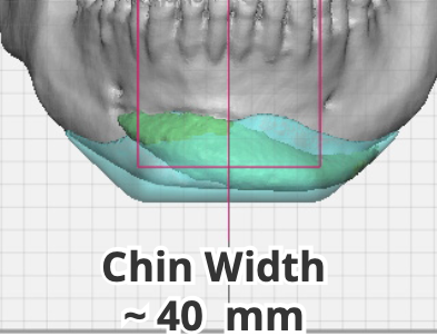 square chin implant design front view Dr Barry Eppley - Explore Plastic ...