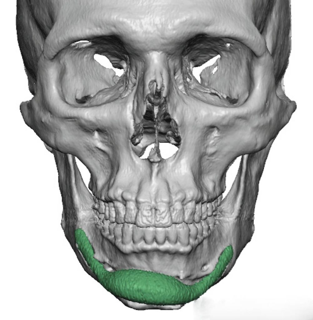 PLastic Surgery Case Study - Correcting Chin Implant Asymmetry and ...