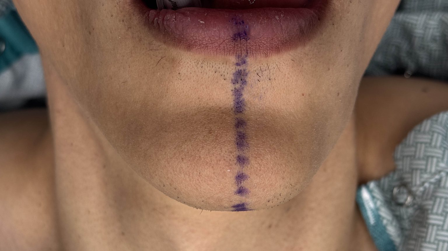 standard square chin implant placement front view Dr Barry Eppley ...