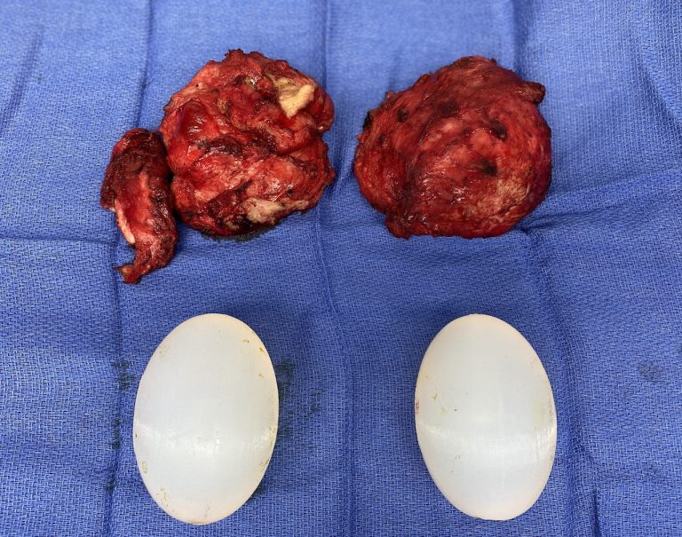 Silicone Scrotal Injections and Custom Testicle Implants - Explore ...