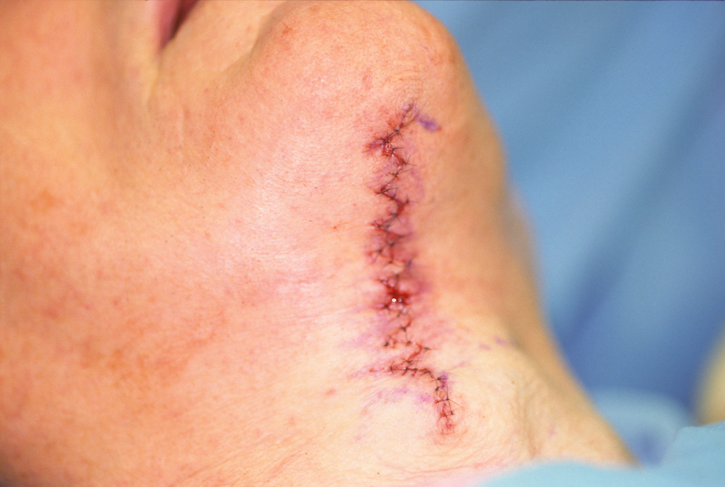 zipper necklift closure Dr Barry Eppley - Explore Plastic Surgery