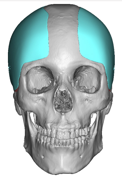 Plastic Surgery Case Study - Custom Extended Head Widening Implants for ...
