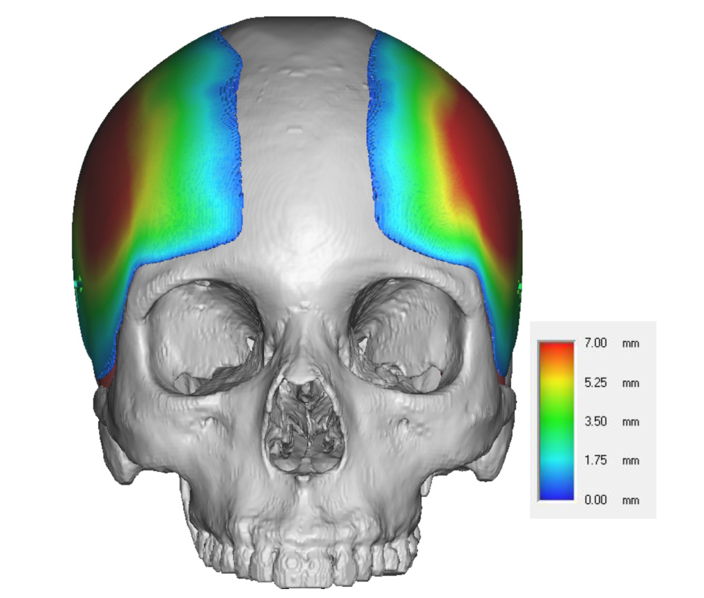Plastic Surgery Case Study - Custom Extended Head Widening Implants for ...
