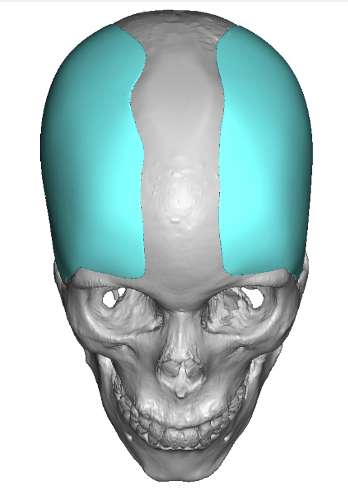 Plastic Surgery Case Study - Custom Extended Head Widening Implants for ...