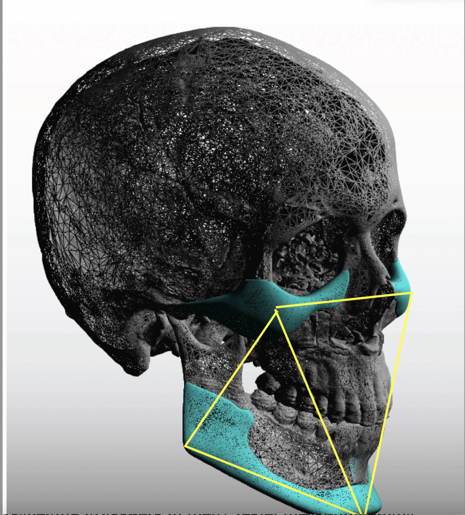 Plastic Surgery Case Study - Male Custom Cheek and Jawline Implants ...