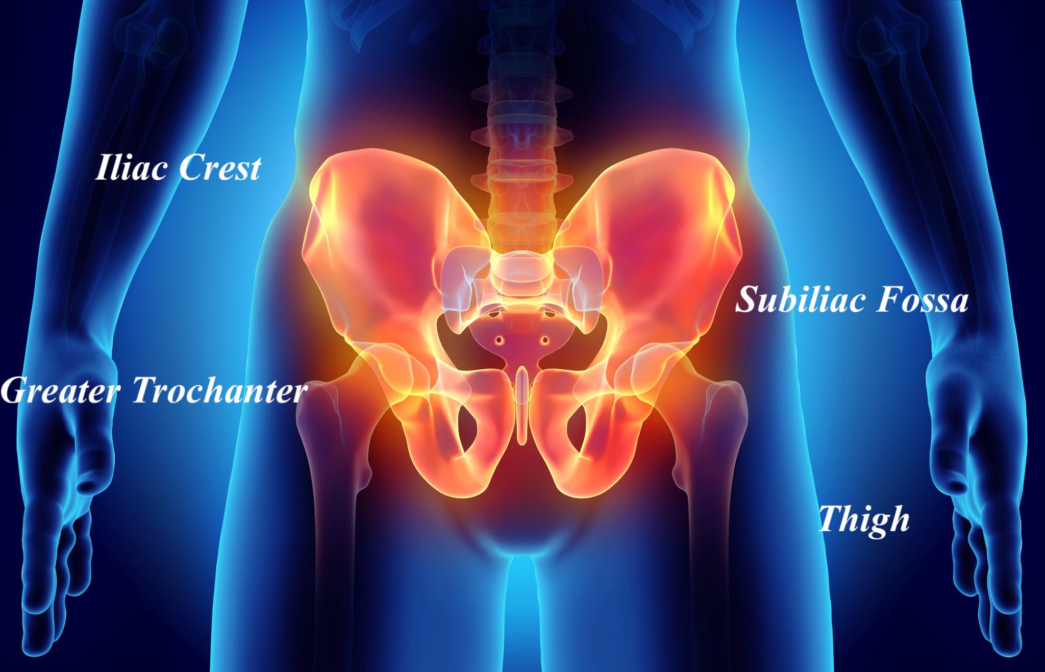 The Subiliac Hip Implant in the Thin Female Patient - Explore Plastic ...