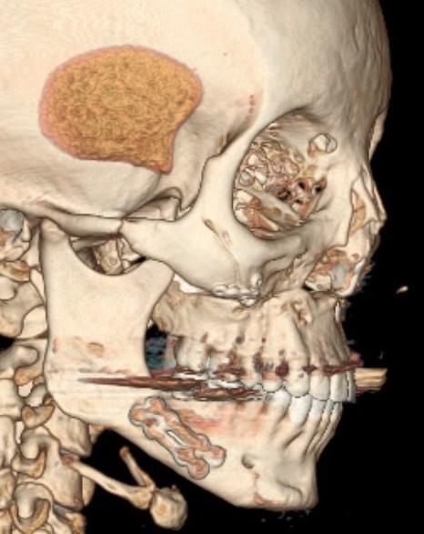 cheekbone reduction osyeotomies 3D CT scan right side view Dr Barry ...