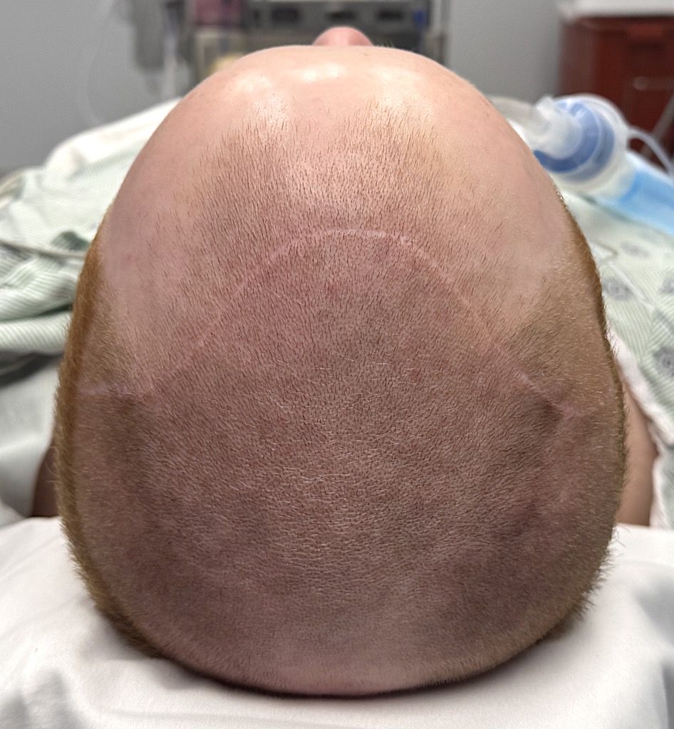 corornal scalp scar appearance Dr Barry Eppley - Explore Plastic Surgery