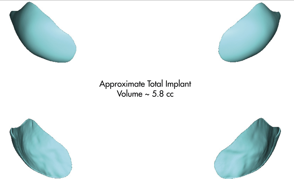 Plastic Surgery Case Study - Male Custom Cheek and Jawline Implants ...