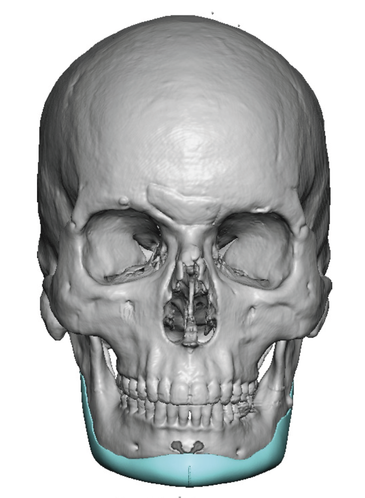 Plastic Surgery Case Study - Custom Jawline Implant for Secondary ...