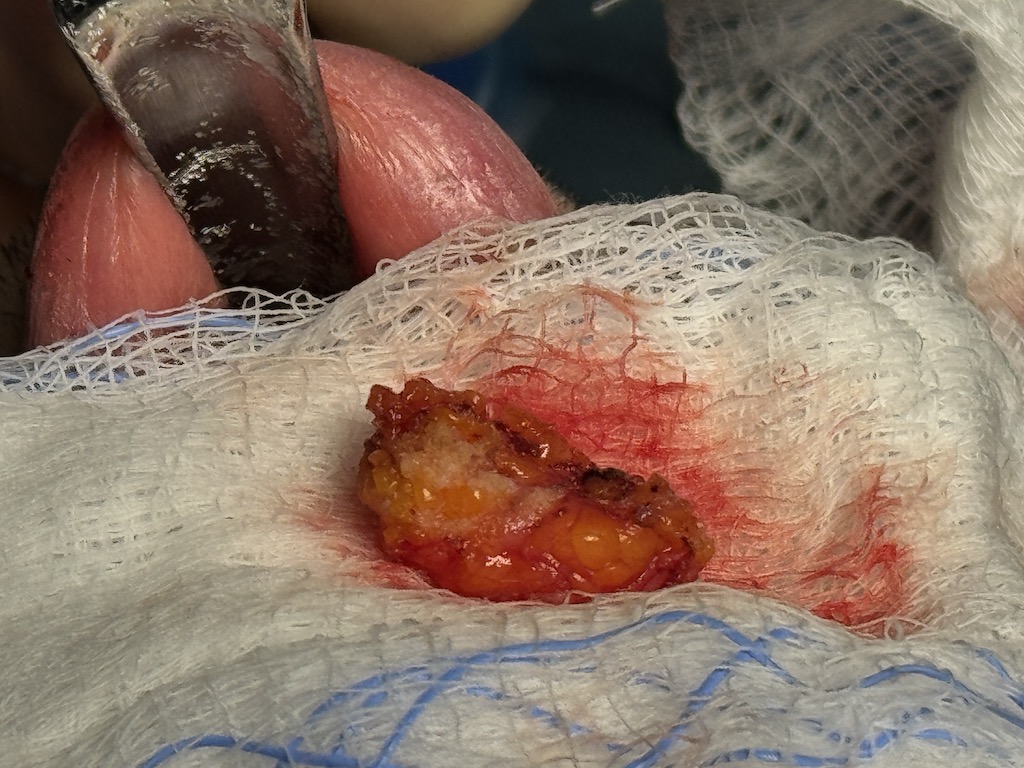 dermal-fat graft harvest Dr Barry Eppley - Explore Plastic Surgery