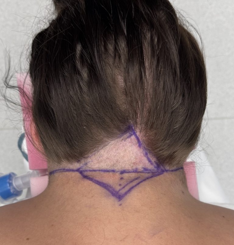 Plastic Surgery Case Study - Webbed Neck Correction Combined with ...