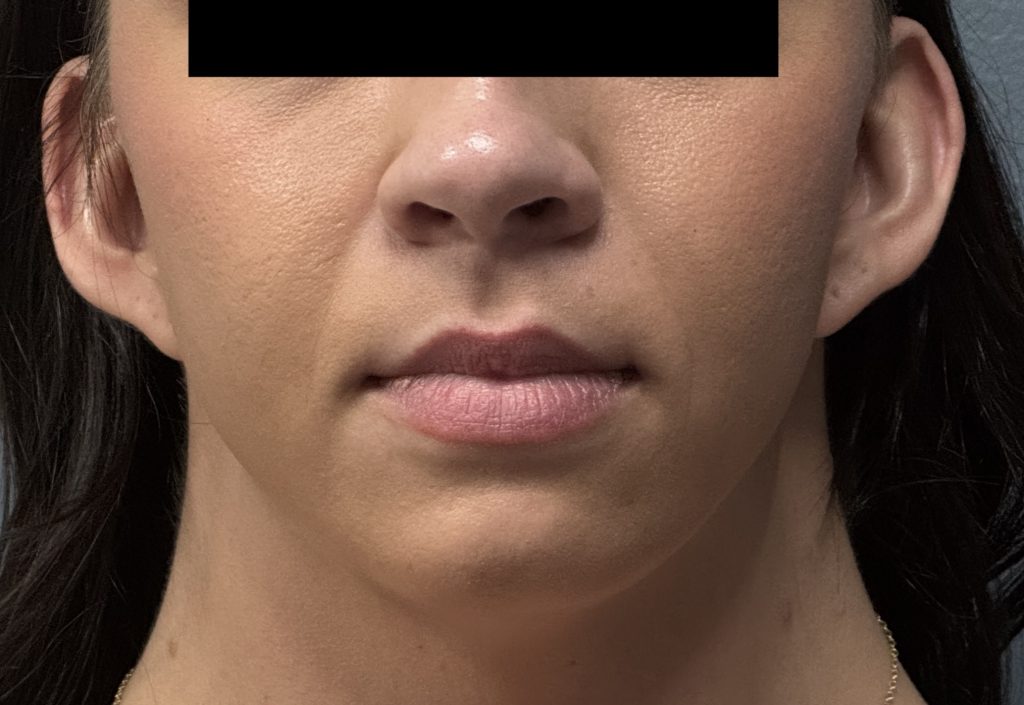 Plastic Surgery Case Study - The Prone Setback Otoplasty - Explore ...