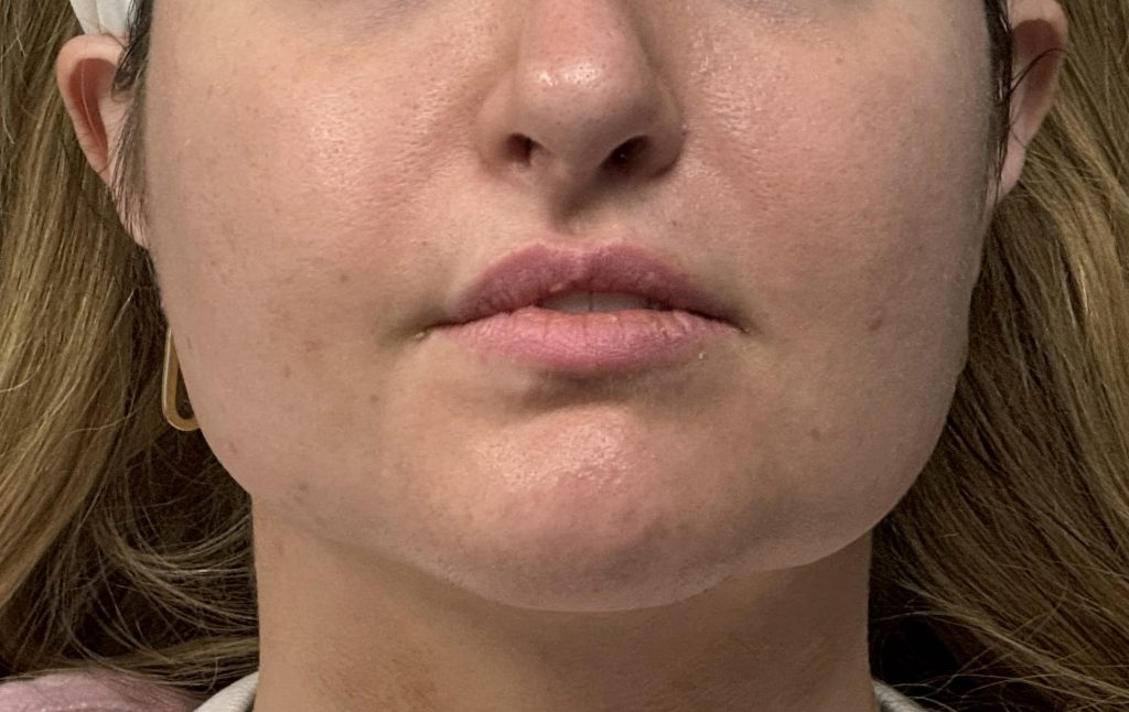 Plastic Surgery Case Study - Long Term Results of Female Jaw ...