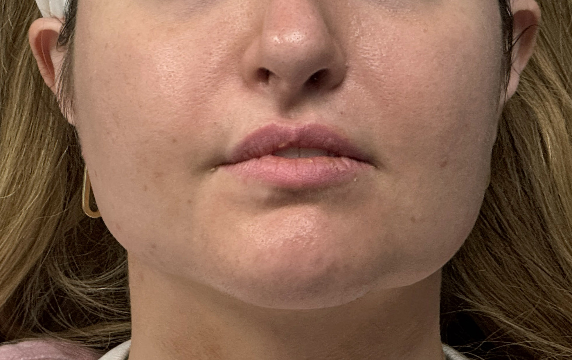 female sg + jaw angle implants front 2 Dr Barry Eppley copy - Explore ...