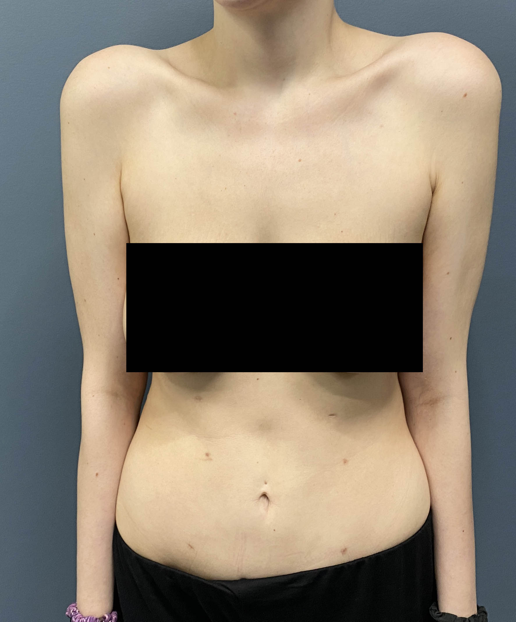 Plastic Surgery Case Study - Long Term Results of the Vertical Backlift Corset Tightening ...