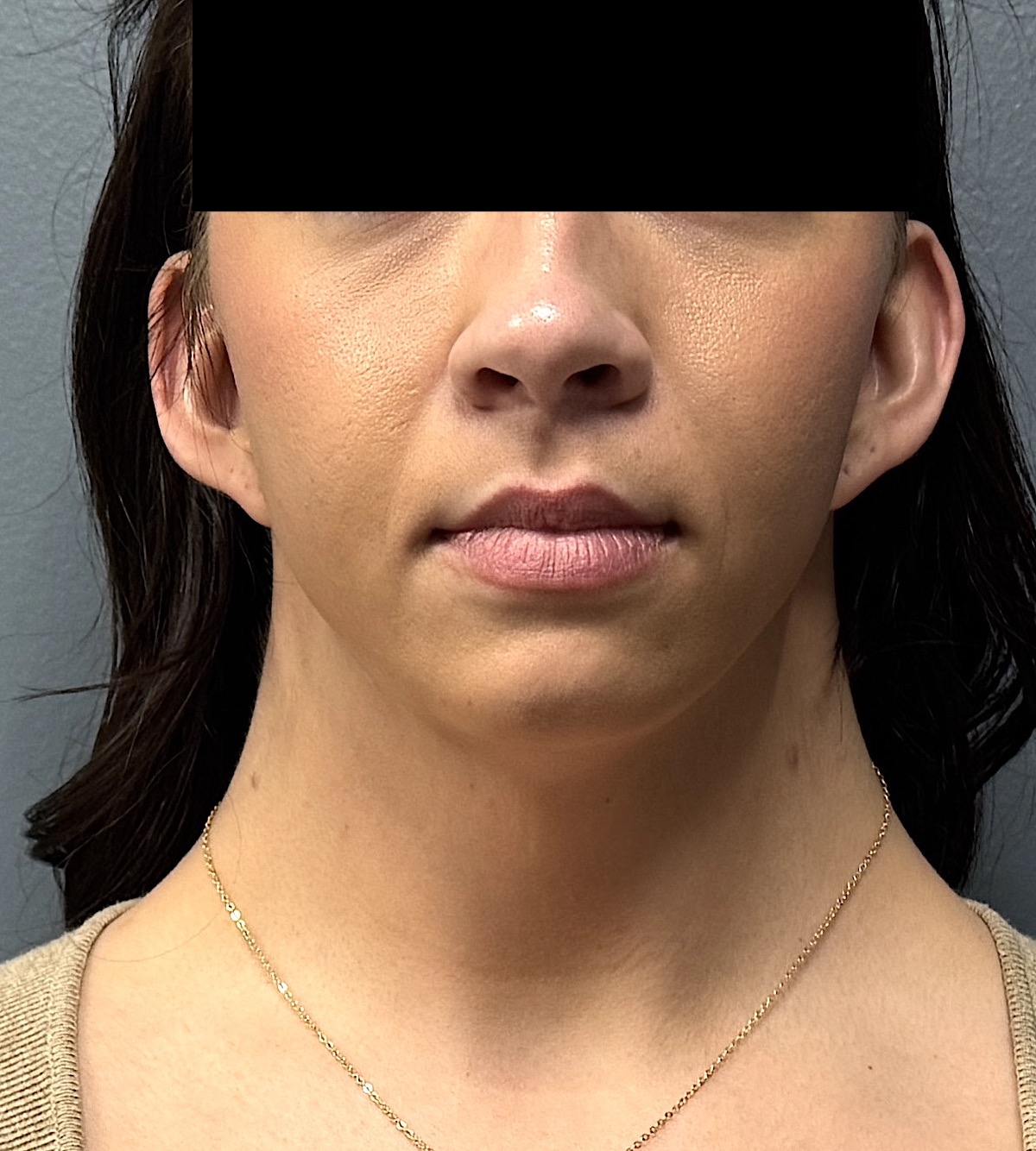 female webbed neck and otoplastyb preop dr barry eppley - Explore ...