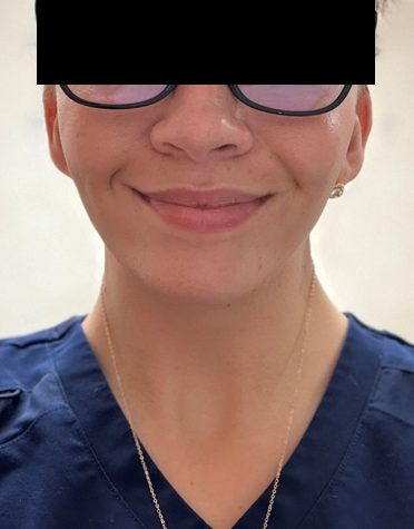 female webbed neck correction and otoplasty result front view dr barry ...