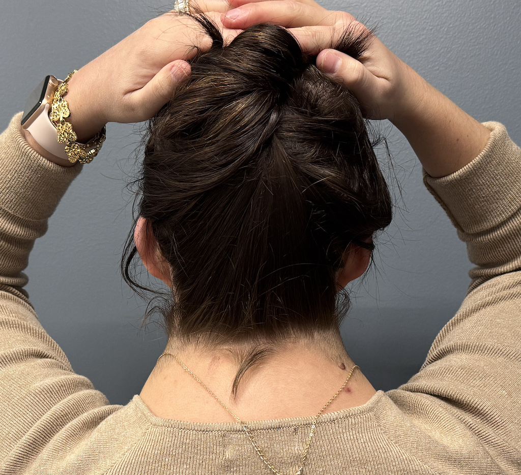 female webbed neck repair back 1 Dr Barry Eppley - Explore Plastic Surgery