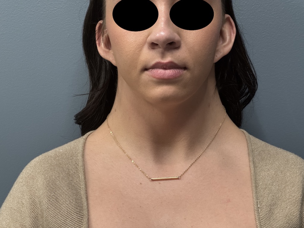 female webbed neck rfepair front 1 Dr Barry Eppley copy - Explore ...