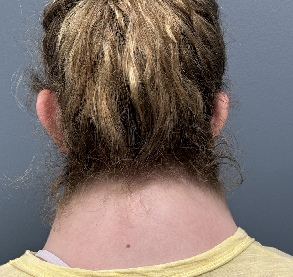 Plastic Surgery Case Study - Long Term Results in a Female Webbed Neck ...