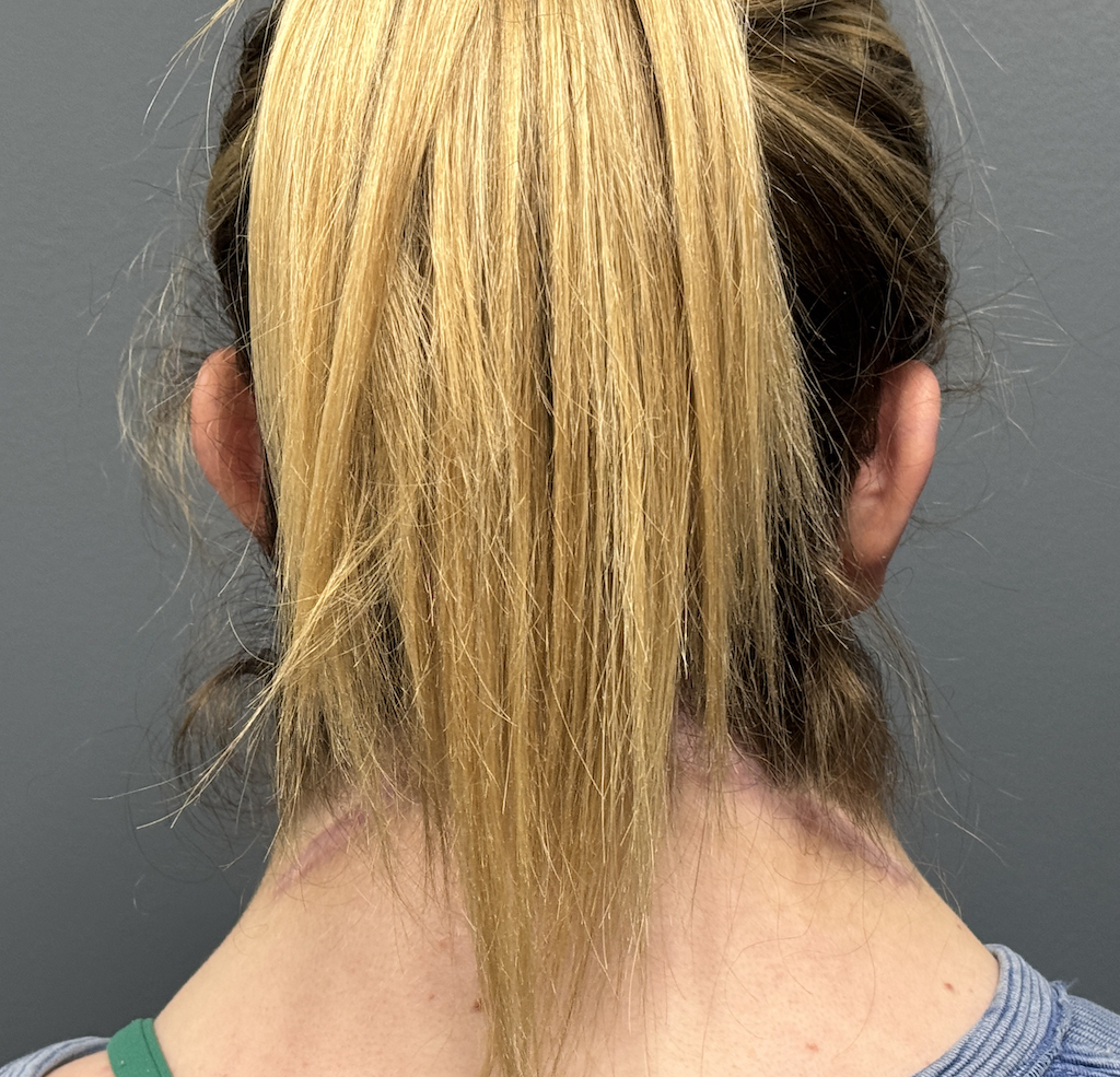 Plastic Surgery Case Study - Long Term Results in a Female Webbed Neck ...