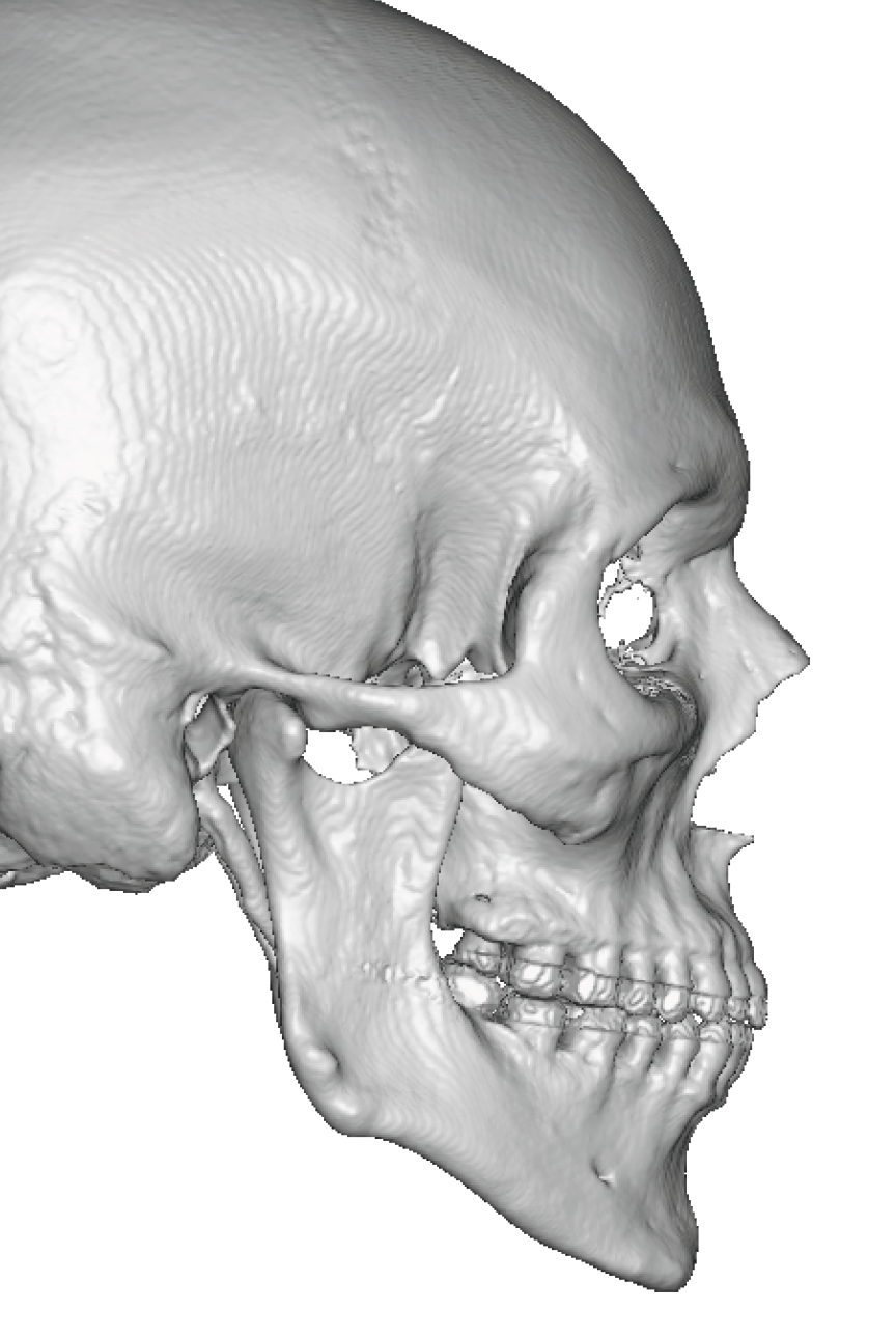 Plastic Surgery Case Study - Male Custom Cheek and Jawline Implants ...