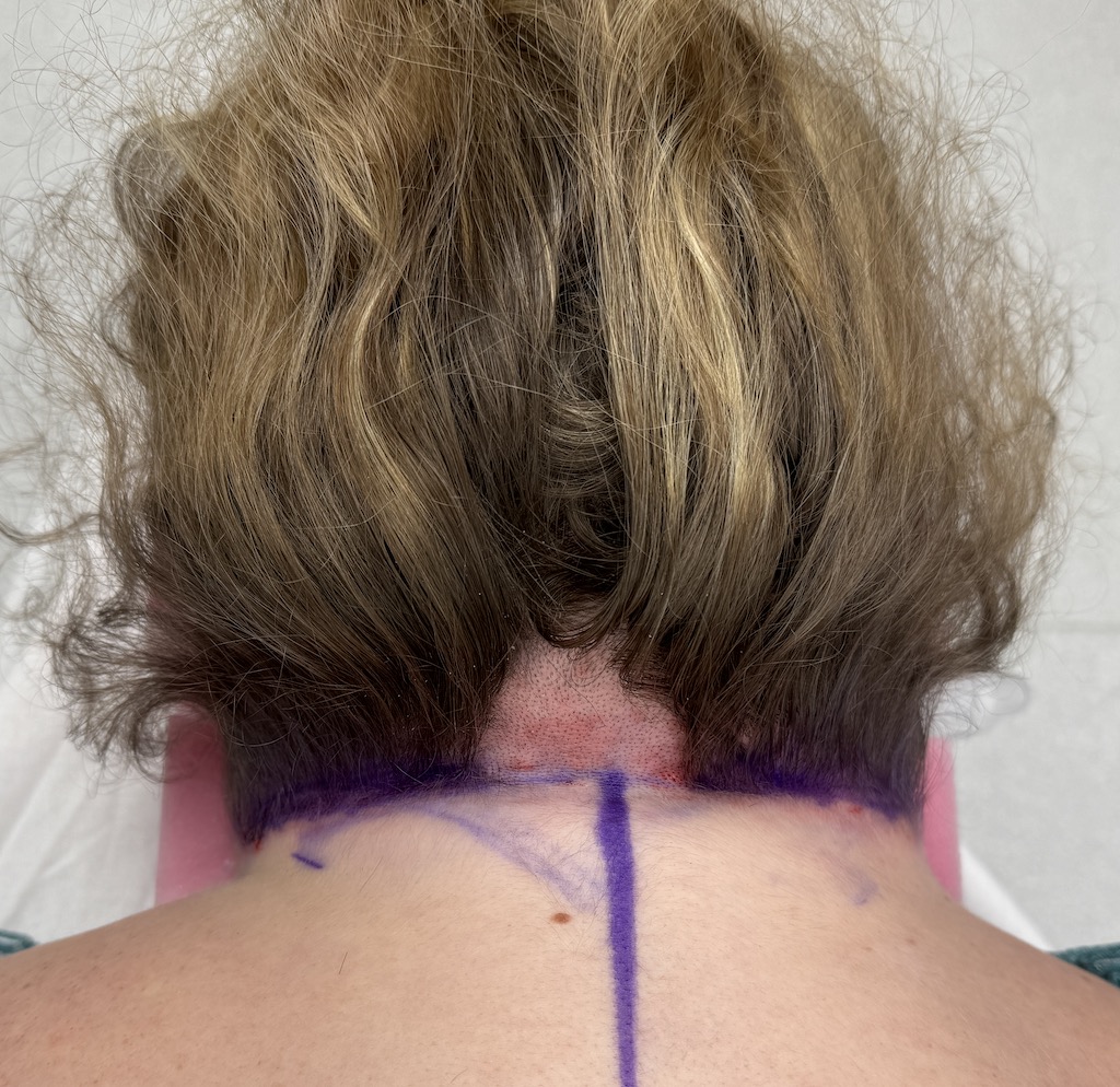 Plastic Surgery Case Study - Long Term Results in a Female Webbed Neck ...