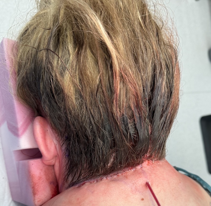 inverted T webbed neck repair intraop postop Dr Barry Eppley - Explore ...