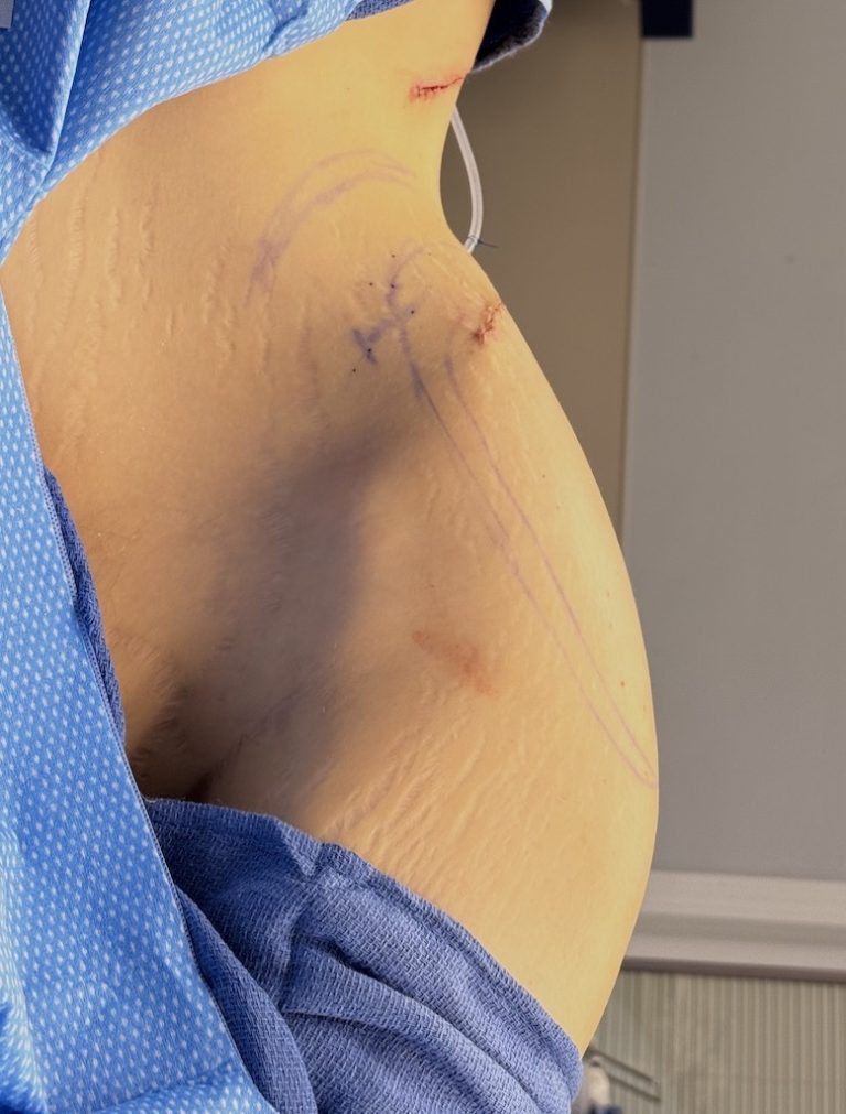left subiliac hip implamnt placement front view Dr Barry Eppley ...